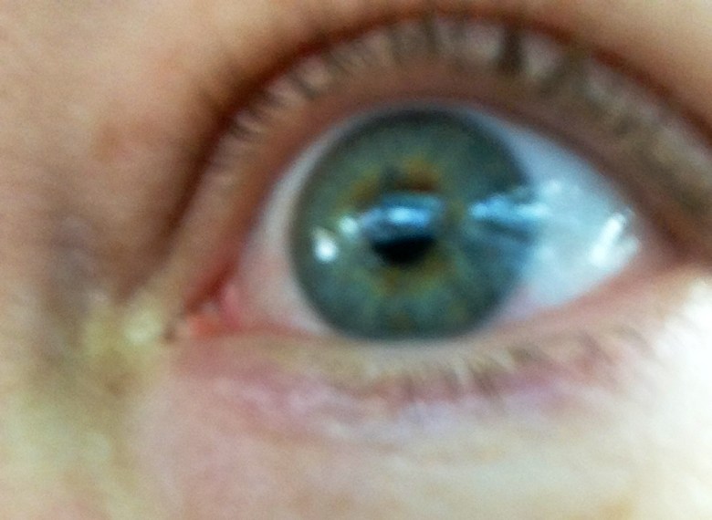 Sjogrens and the benefits of tear duct cauterization | The Pigaloo Diaries